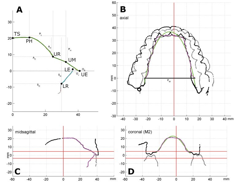 Dental fricatives: Patterning, evolution, and factors affecting a rare ...